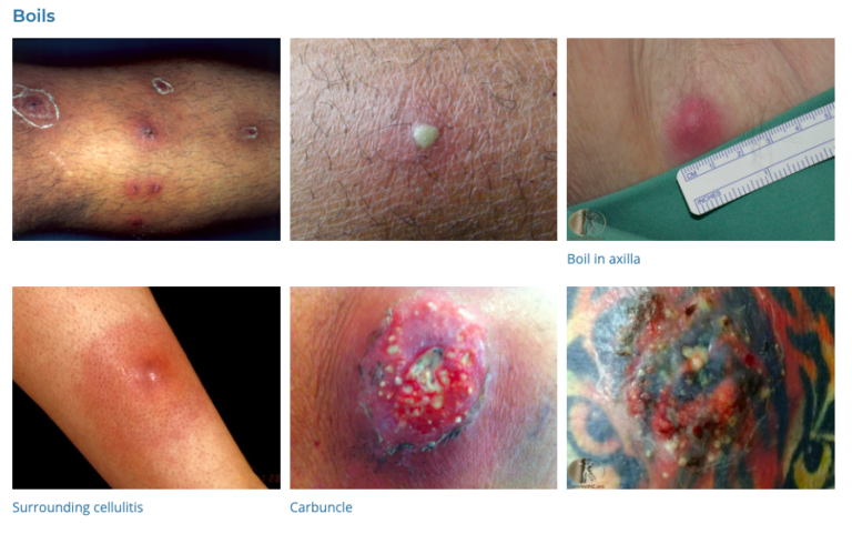 Boil/Carbuncle - GP Exams