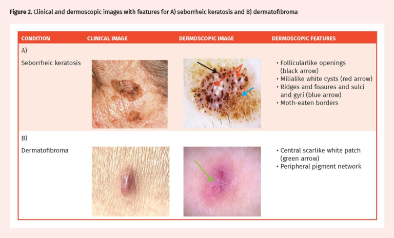 Dermatoscopy Findings - GP Exams