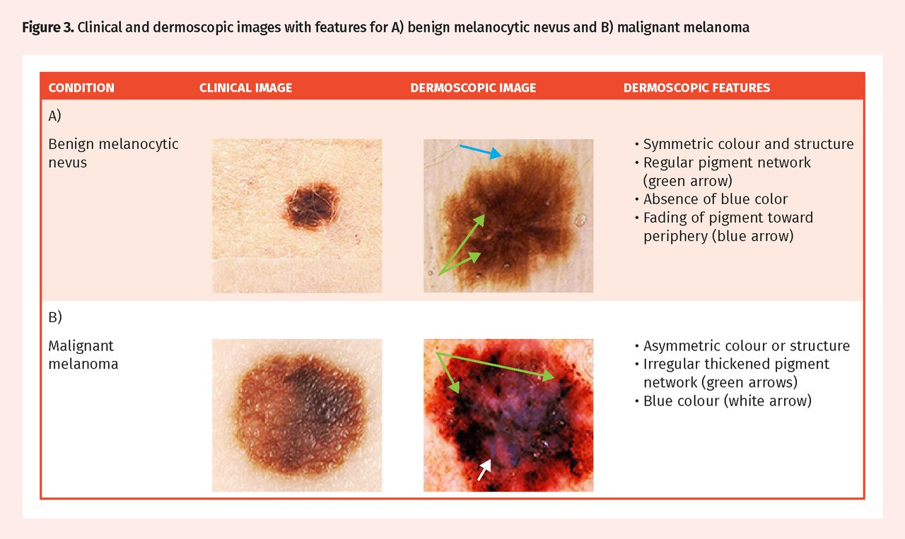 Dermatoscopy Findings - GP Exams