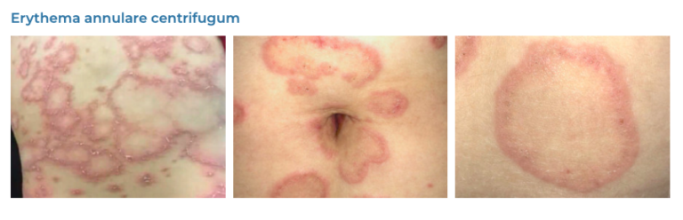 Annular Rash (Like Ringworm) - GP Exams