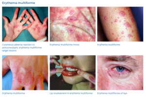 Annular Rash (Like Ringworm) - GP Exams