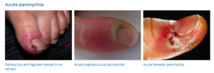 Infected finger/toe - GP Exams