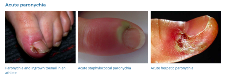 Infected finger/toe - GP Exams