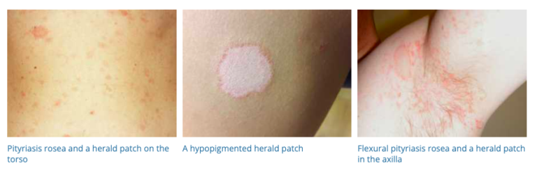 Annular Rash (Like Ringworm) - GP Exams