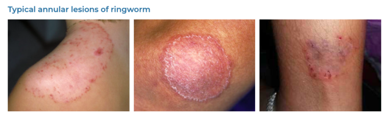 Annular Rash (Like Ringworm) - GP Exams