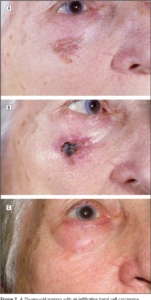 Aldara and Efudex Cream for Skin Cancer - GP Exams