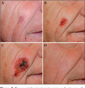 Aldara and Efudex Cream for Skin Cancer - GP Exams