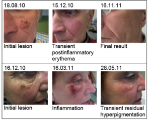 Aldara and Efudex Cream for Skin Cancer - GP Exams